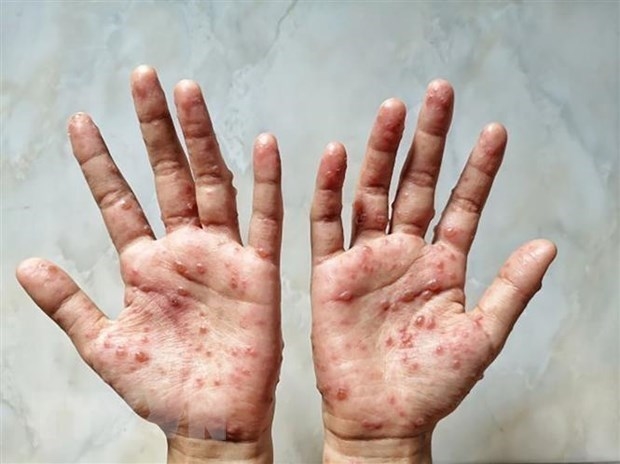 Government urges greater effort to prevent monkeypox